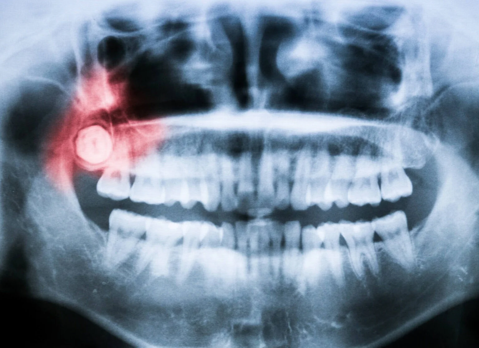 The Different Types of Impacted Wisdom Teeth (And What They Mean for ...