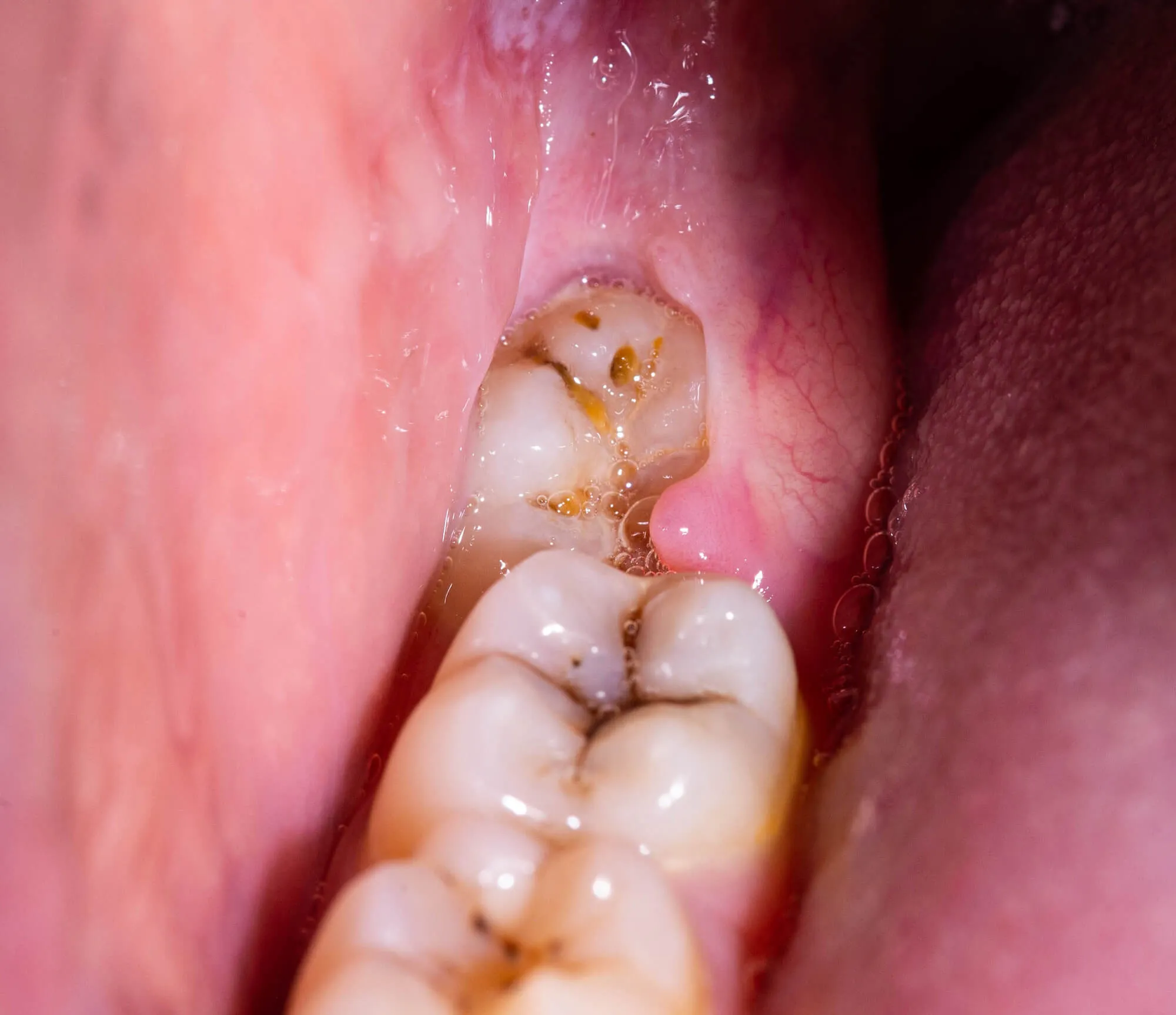 How Tooth Decay Develops Over Time - Champagne Dental Care